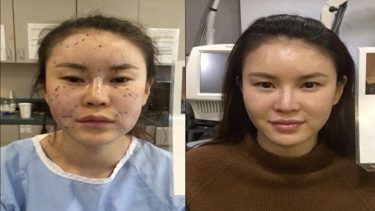 Baby face by Fat Transfer injection | Dailynewstv.co